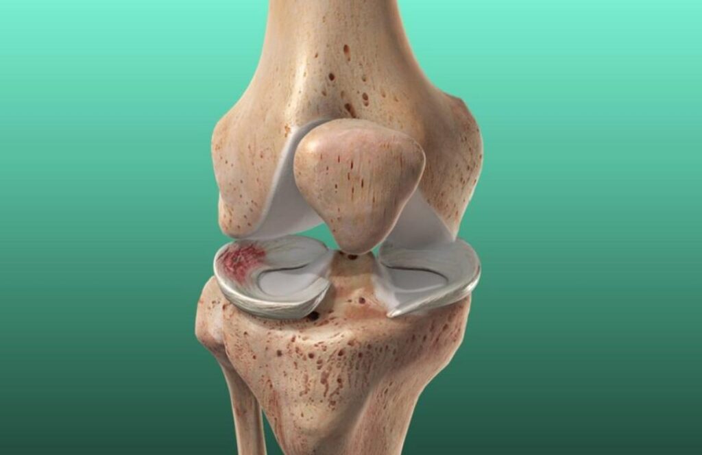 Tratamento cirúrgico de lesão meniscal – Dr. Roberto de Carvalho